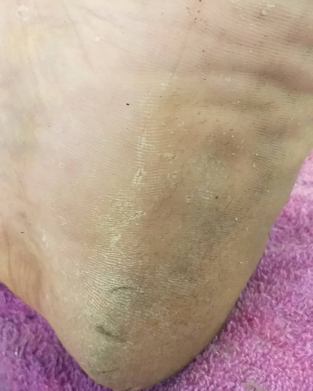 Pés Ressecados: Causas e Tratamentos Caseiros