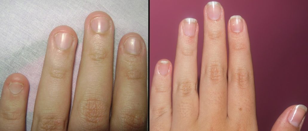 Dicas Infalíveis para parar de Roer Unha: 15 Dicas Importantes!