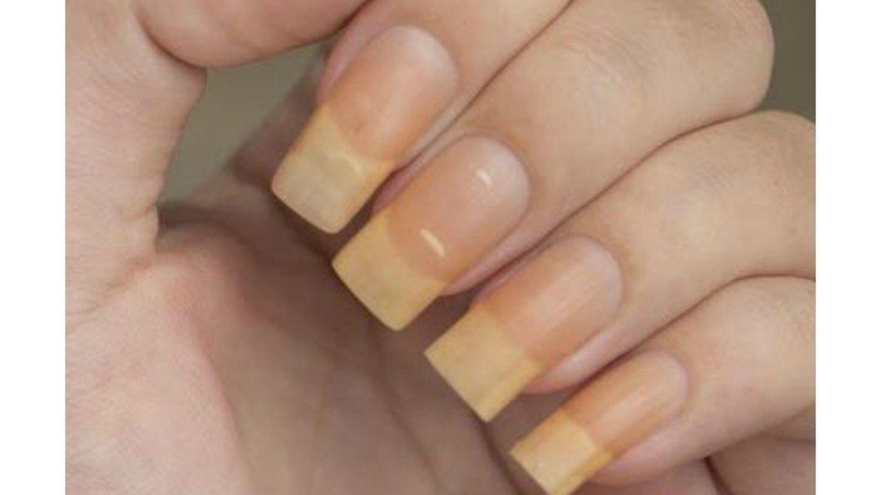 Unhas Quebradiças: O que é, e saiba o que fazer para evitar