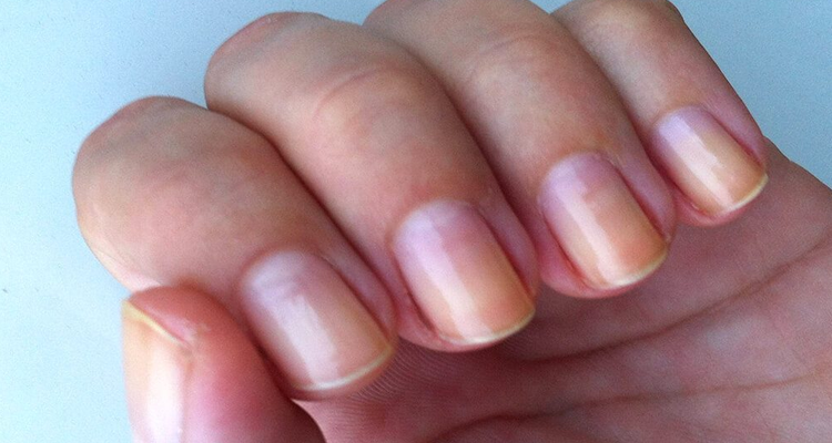 Unhas Quebradiças: O que é, e saiba o que fazer para evitar