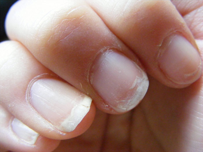 Unhas Quebradiças: O que é, e saiba o que fazer para evitar